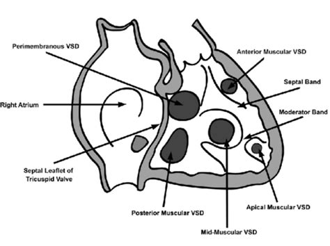 Vsd Ventricular Septal Defects Flashcards Quizlet