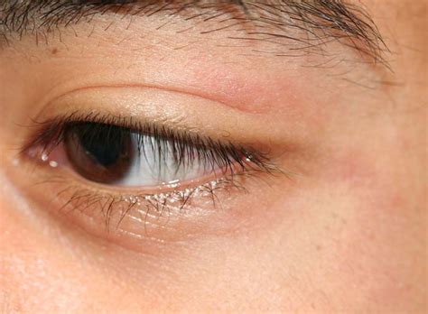 Eyelid Dermatitis Eyelid Dermatitis Xeroderma Of The Eyelids Eczema