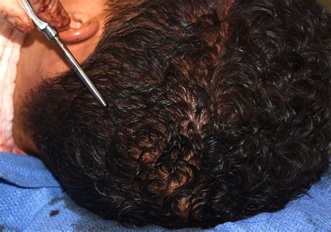 Technical Strategies Maximizing Scalp Mobilization In Hairline Advancement Surgery Explore