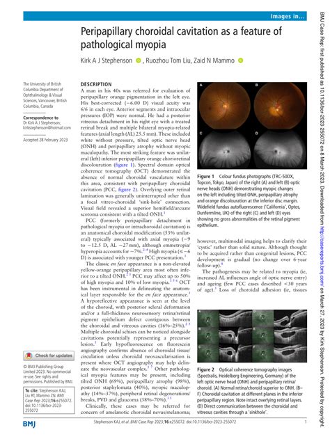 Pdf Peripapillary Choroidal Cavitation As A Feature Of Pathological Myopia