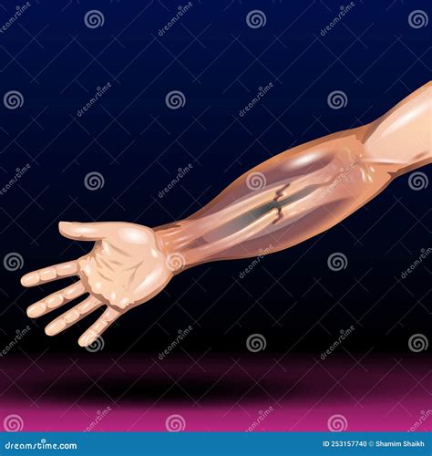 Hand Bone Fracture Distal Radius Fracture And Broken Arm Bone Types Anatomy Vector