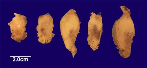 Serial Sections Of The Virchow Node The Cut Surfaces Are Almost