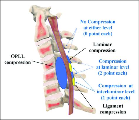 Schematic Drawings Of The Posterior Compression Score Of The Spinal