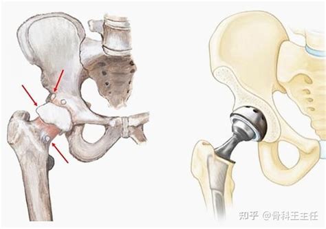 髋关节置换手术后，哪个部位最疼，大概要疼多长时间 知乎
