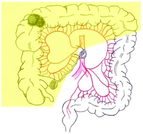 Resection Margins In Hepatic Flexure Tumors Download Scientific Diagram