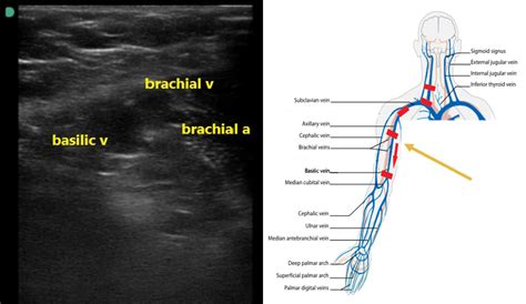 Basilic Vein Anatomy Ultrasound At Donna Lahti Blog
