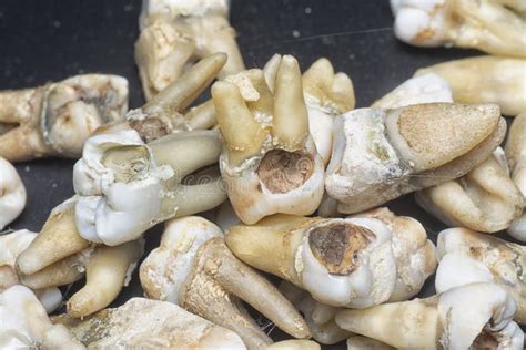The Bundle Of Unwanted Extracted Decay Human Teeth Stock Image Image Of Pile Hole