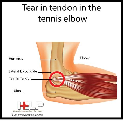 Tendon And Ligament Disorders At The Elbow Artofit