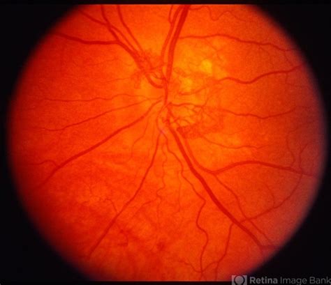Extensive Neovascularization Of The Disc Retina Image Bank