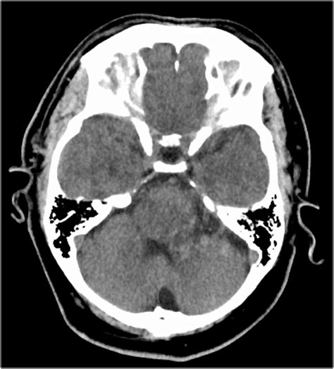 Midbrain Ct