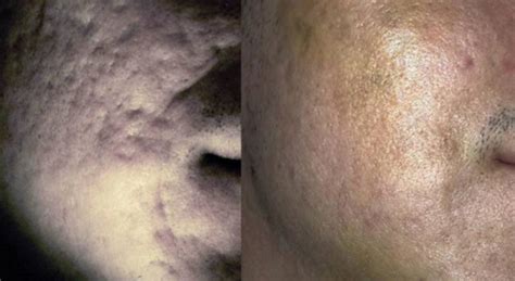 Doctor Sadove Gainesville Florida 25 Year Old Man Treated With Acne Scars Treatment Results