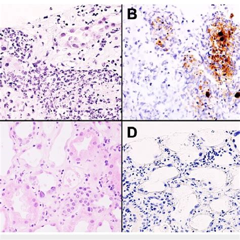 Representative Micrographs From Patient Three During Active Infection