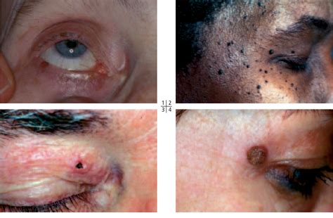 Palpebral Branch Of Infratrochlear Nerve Semantic Scholar