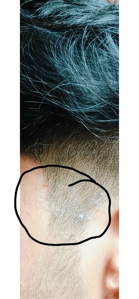 What Is This Condition On My Scalp R Dermatologyquestions