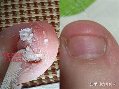 想要彻底告别灰指甲，必须脱掉病甲露出甲床，然后杀灭甲床下的真菌，灰指甲才能康复，6年的宝藏经验分享 知乎