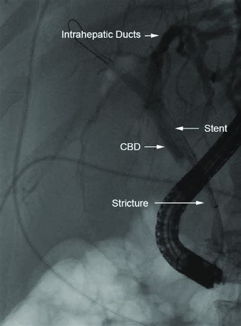 Cholangiogram Showing Dilation Of The Common Bile Duct Intrahepatic