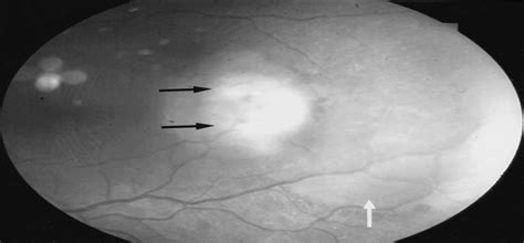 Subretinal Fluid Analysis In The Diagnosis Of Choroidal Tube Retina