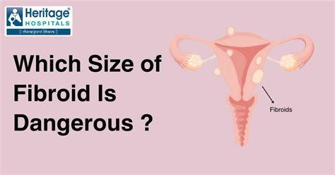 Which Size Of Fibroid Is Dangerous About Risk And Treatment