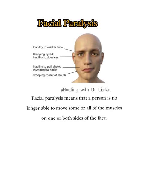 Facial Paralysis Pdf