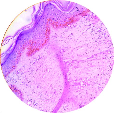 Atrophy Of The Epidermis And Reticular Dermis And Replacement Of The