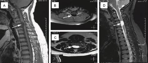 Preoperative Mri Examination Of Cervical Spine A Sagittal Scanning Download Scientific