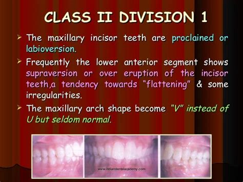 Malocclusion Certified Fixed Orthodontic Courses By Indian Dental