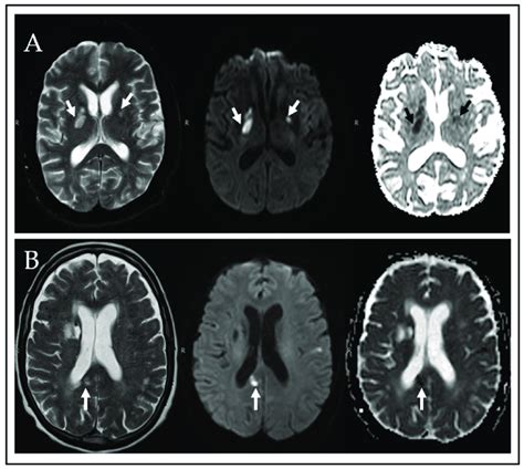 Mri Findings In Cm Including Ischemic Infarcts Or Download Scientific Diagram