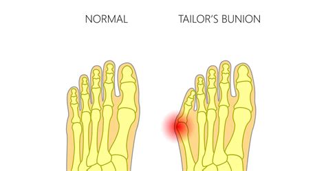 Foot Posture And Gait Disorders Brisbane Brisbane North Clinic