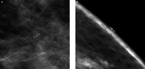 How To Interpret Microcalcifications Abdominal Key
