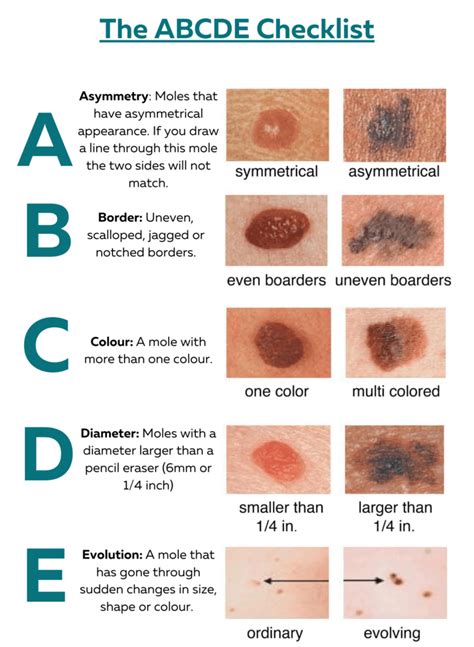 Melanoma Skin Moles