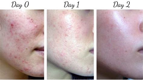 How To Remove Pimples Overnight Glowpink