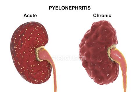 Comparison Of Gross Anatomy Of Acute And Chronic Pyelonephritis Illustration — Biology
