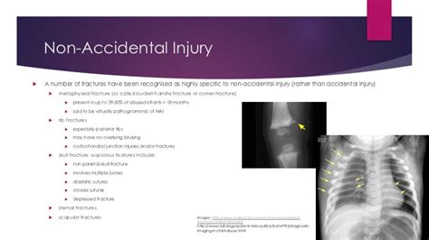 Paediatric Fractures — Learned