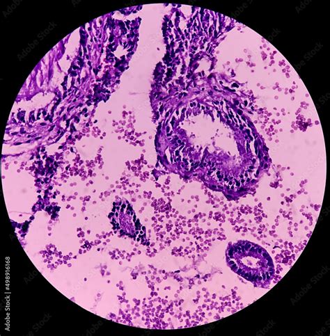 Endocervical Tissue Biopsy Photomicrograph Show Part Of Ectocervix And Few Fragmented