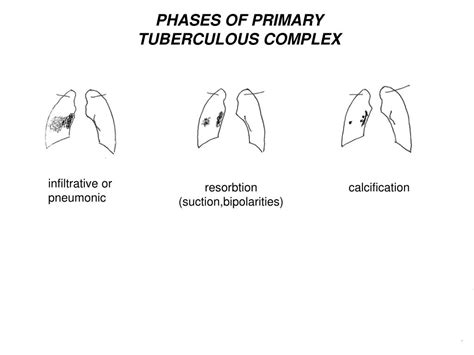 Ppt Primary Tuberculosis Powerpoint Presentation Free Download Id