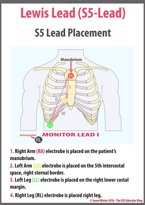 Ecg Educator Blog Atrial Flutter