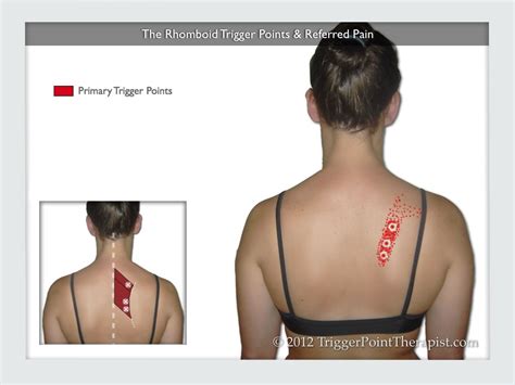 Rhomboid Trigger Points A Pain Between The Shoulder Blades