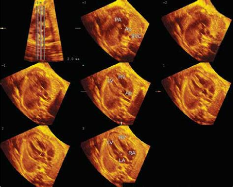 Technique For Obtaining Standard Echocardiographic Planes Using The