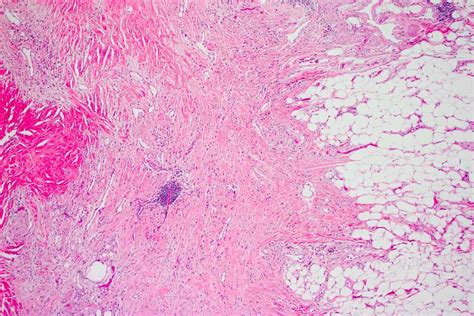 50 Facts About Idiopathic Sclerosing Mesenteritis