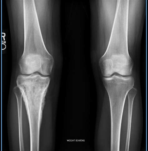 21 Y O Female With Chronic Osteomyelitis R Radiology