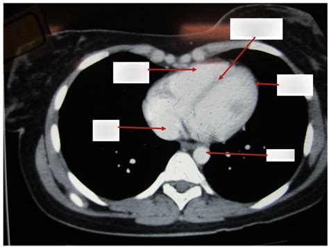 Heart Ct Scan Diagram Quizlet
