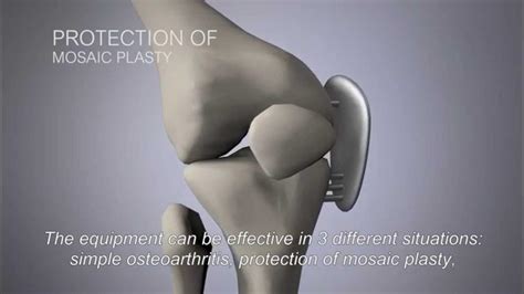 Knee Exoprosthesis Exoprothèse De Genou Youtube Knee Exoprosthesis Exoprothèse De Genou Youtube