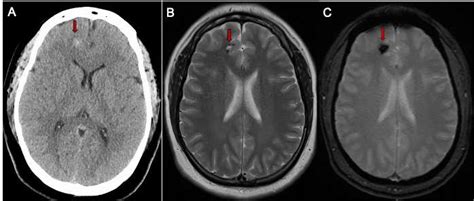 Cavernous Malformation Cerebrovascular Disease Ucla Health