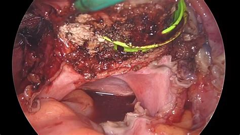 Total Laparoscopic Hysterectomy Unilateral Salpingo Oophorectomy Total