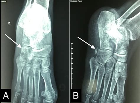 Cuboid Bone Nutcracker Fracture At Wendy Hopkins Blog