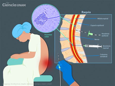 Meningitis ¿existe El Riesgo De Contagiarnos