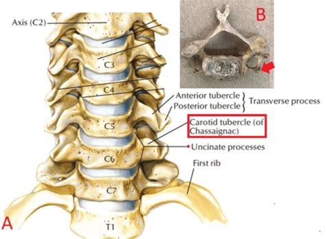 Case 14 Spine Flashcards Quizlet
