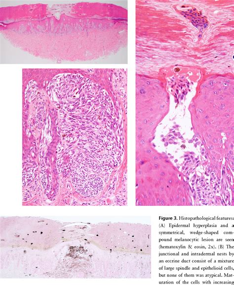 Intradermal Spitz Nevus Histology