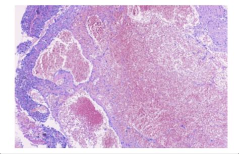 Vascular Ectasia Like Aneurysmal ENT Clinic Of University Of Catania Download Scientific