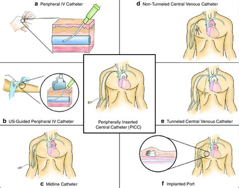 1 Types Of Venous Access Devices Chopra Et Al 2015 Iv Intravenous